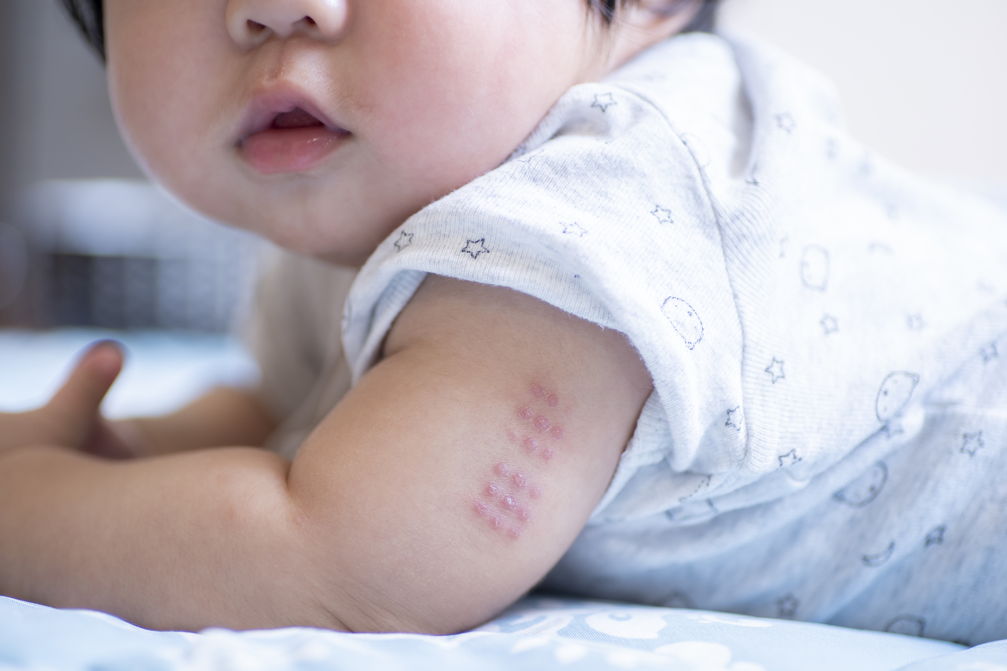 BCG跡が大人になっても消えない。目立たなくするためには